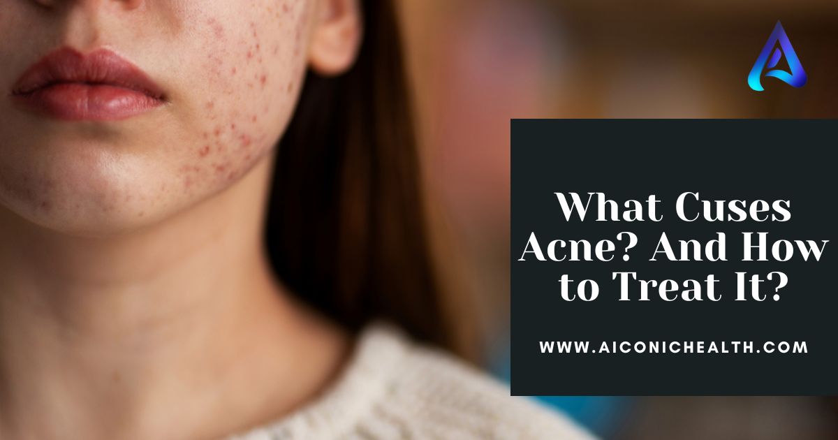 What Causes Acne And How to Treat It?