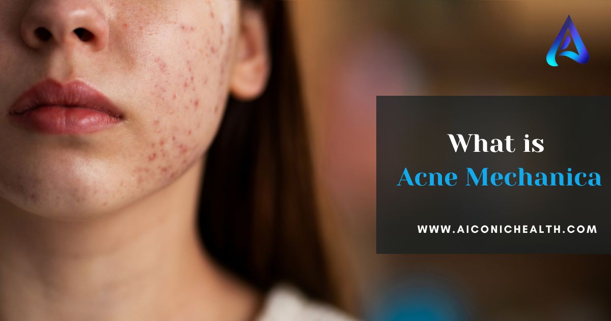 What is Acne Mechanica? | Aiconic Health