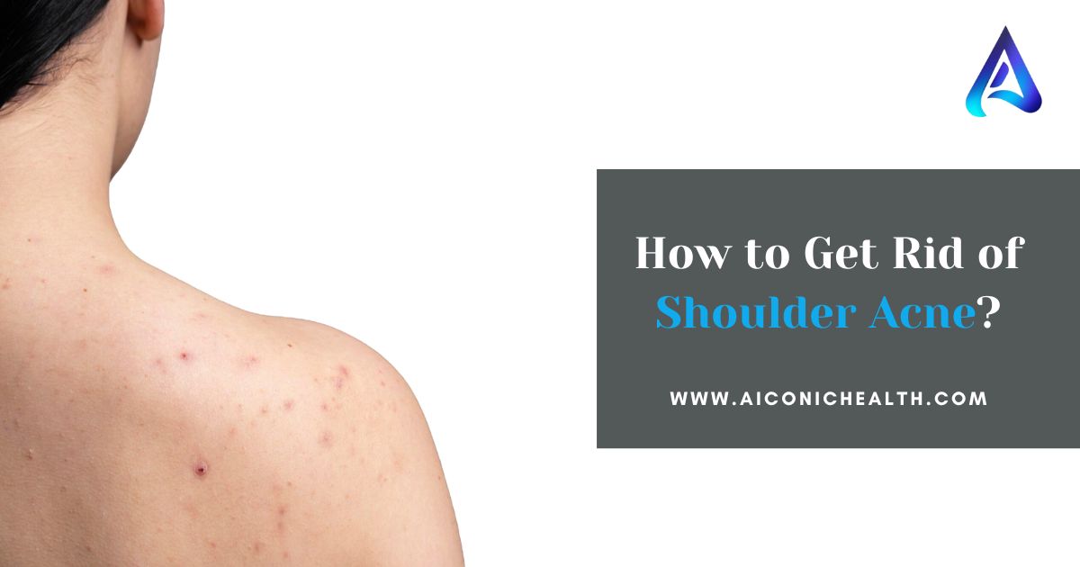 How to Get Rid of Shoulder Acne? | Aiconic Health